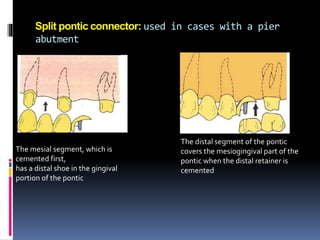 FIXED PARTIAL DENTURE -DESIGN CONSIDERATION | PPTX
