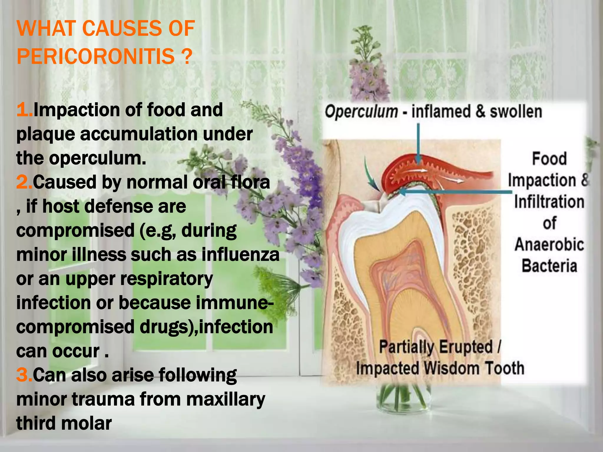 Pericoronitis | PPT