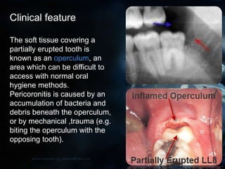 Pericoronitis | PPT