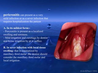 Pericoronitis Infection