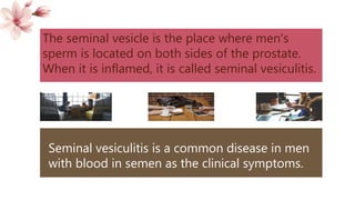 Seminal vesiculitis causes and its effects on fertility | PPT