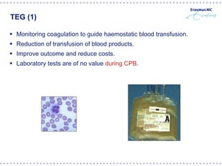 Management of coagulation and transfusion therapy in cardiothoracic ...