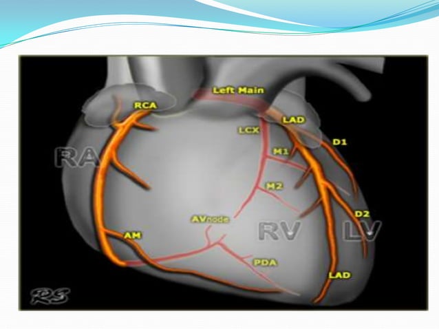 ECG LOCALISATION OF CULPRIT ARTERY IN STEMI | PPTX