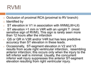 ECG LOCALISATION OF CULPRIT ARTERY IN STEMI | PPTX