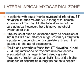 ECG LOCALISATION OF CULPRIT ARTERY IN STEMI | PPTX