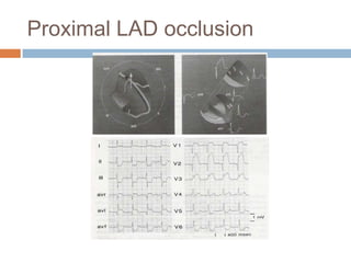 ECG LOCALISATION OF CULPRIT ARTERY IN STEMI | PPTX