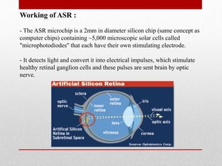 ARTIFICIAL RETINA/EYE (ASR,BIONIC EYE) | PPTX