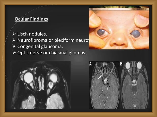 Phakomatoses(Ophthalmology) | PPTX