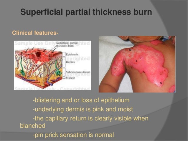 BURN ... by Dr. Rezuan .. JIMCH , Bangladesh