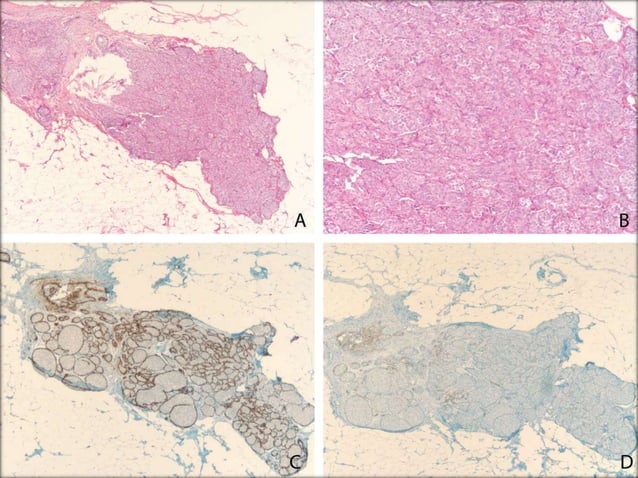 IHC in breast pathology | PPTX