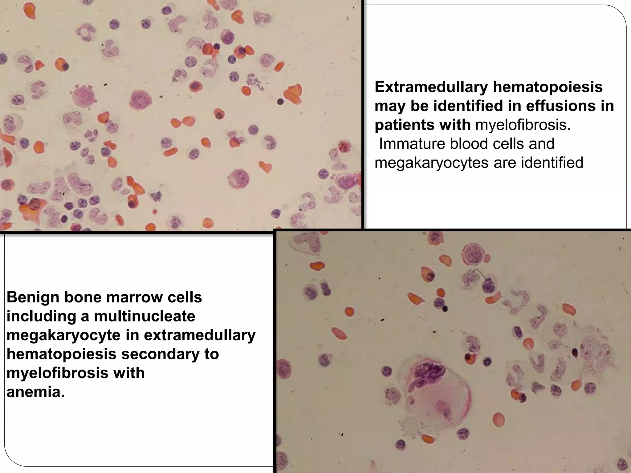 Effusion cytology - Diagnosis. | PPTX