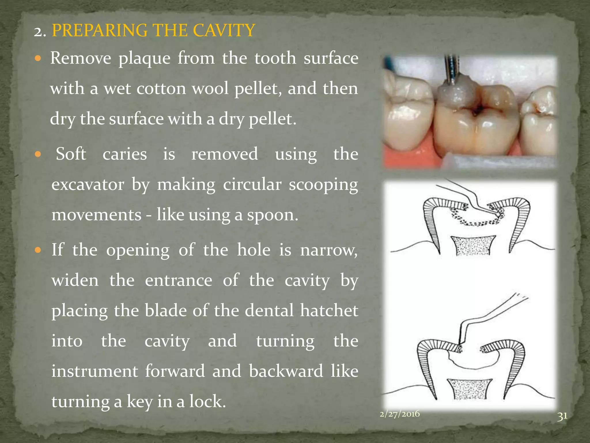 atraumatic restorative treatment | PPTX