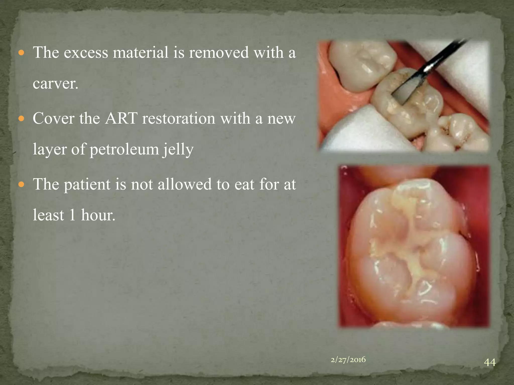 atraumatic restorative treatment | PPTX