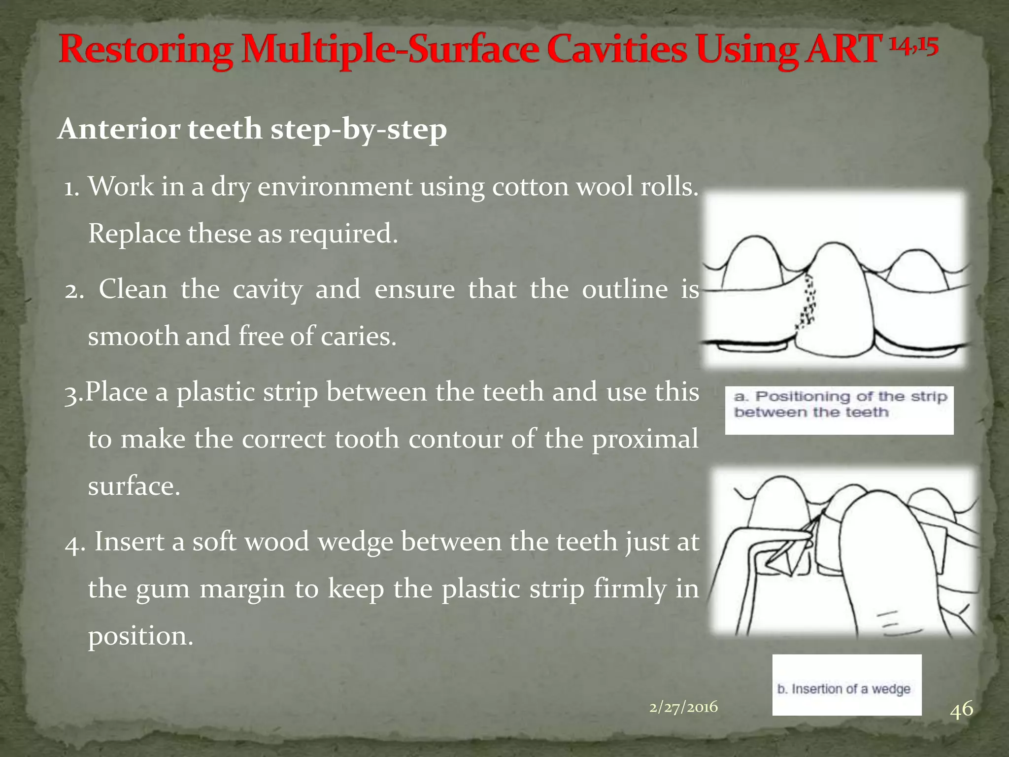 atraumatic restorative treatment | PPTX