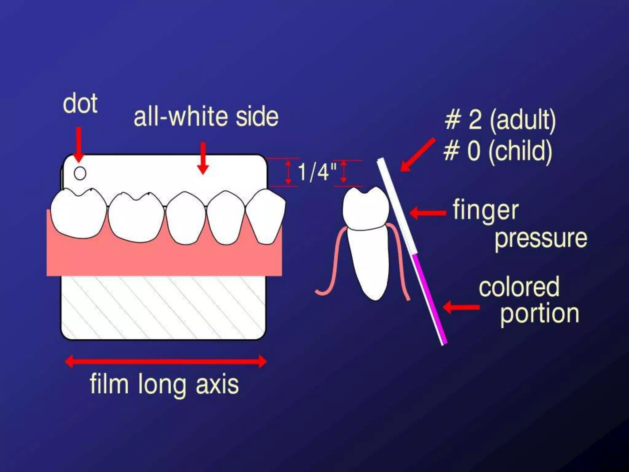 Bisecting angle technique | PPTX