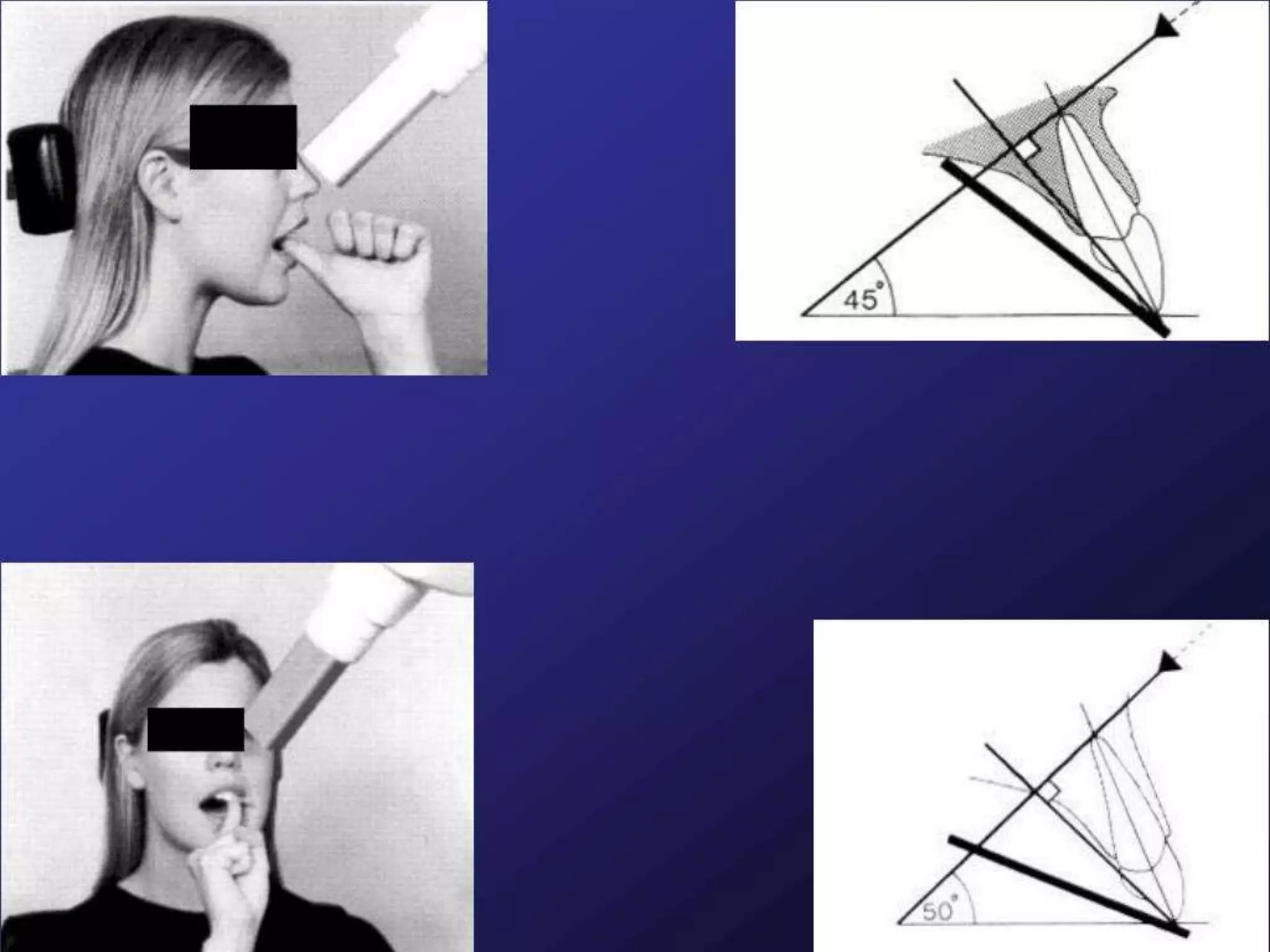 Bisecting angle technique | PPTX
