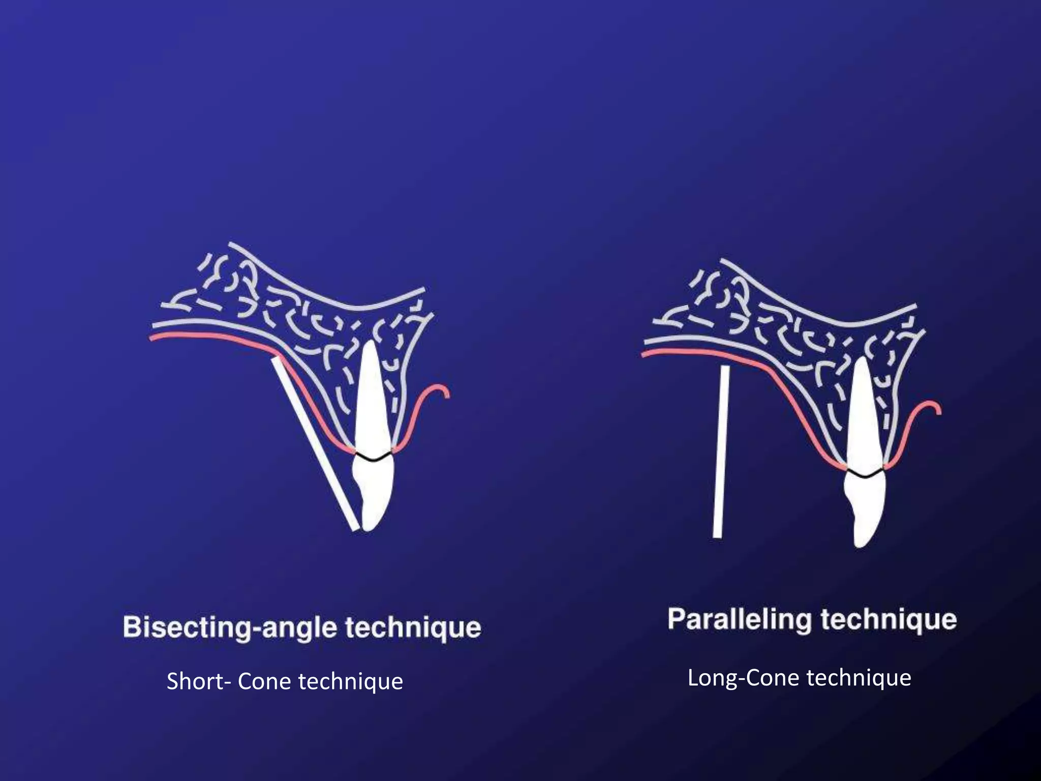 Bisecting angle technique | PPTX