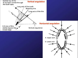Bisecting angle technique | PPTX