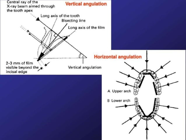 Bisecting angle technique | PPTX