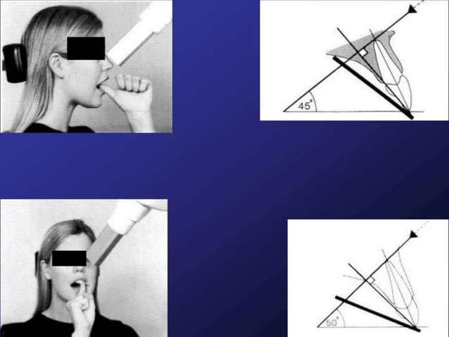 Bisecting angle technique | PPTX