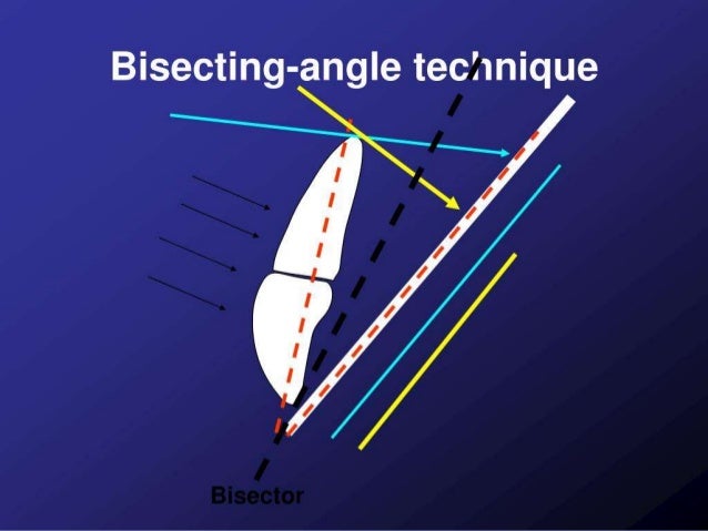 Bisecting angle technique