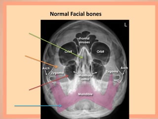 Radiographic anatomy of the face | PPTX