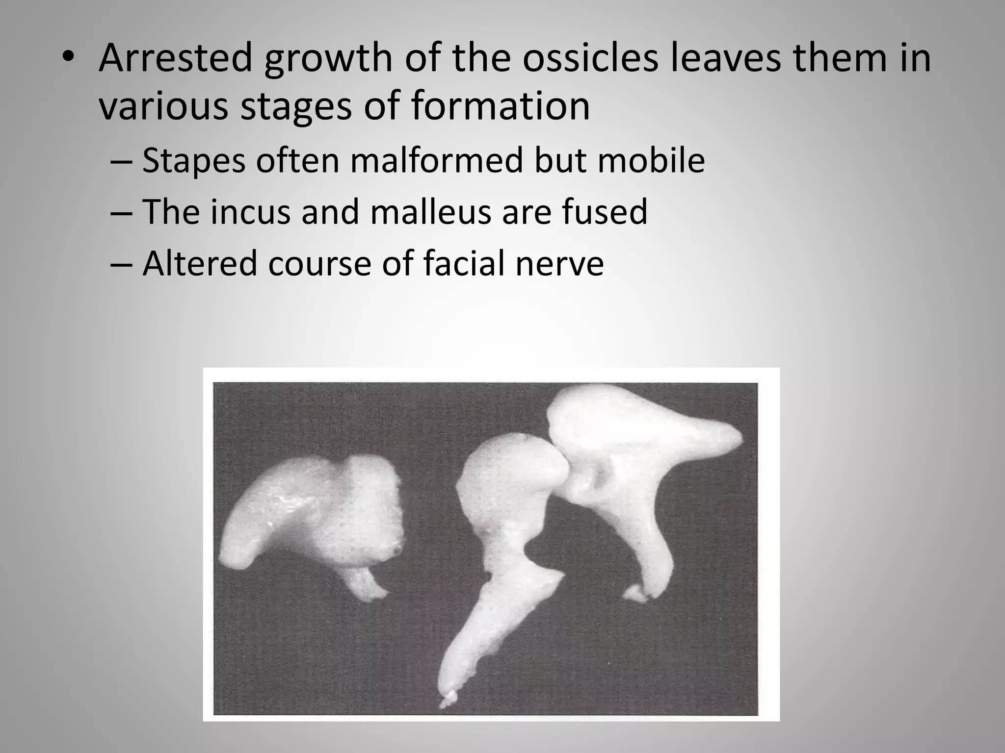 CONGENITAL MALFORATION OF EAR AND ITS MANAGEMENT | PPTX
