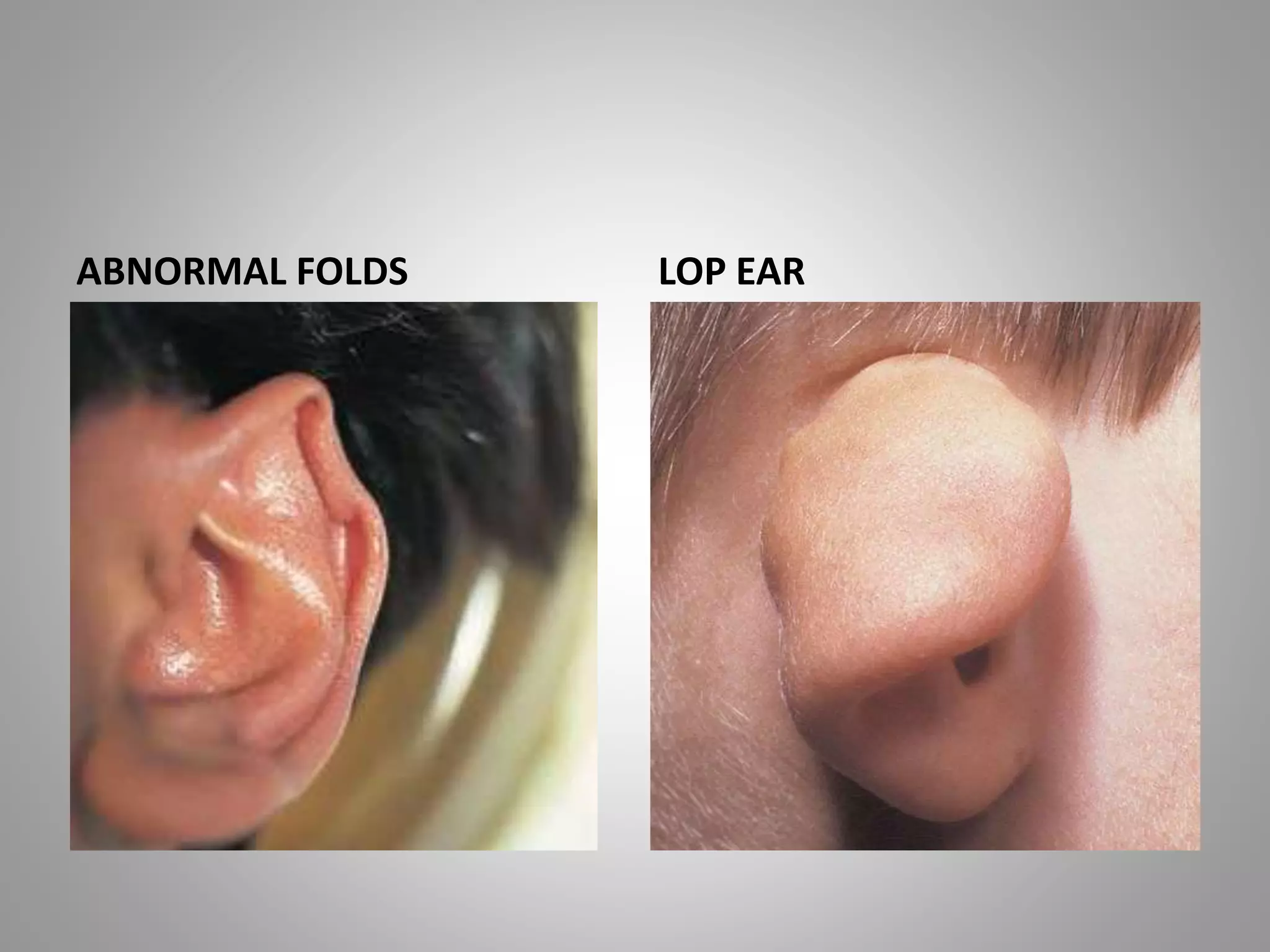CONGENITAL MALFORATION OF EAR AND ITS MANAGEMENT | PPTX | Ear, Nose and ...
