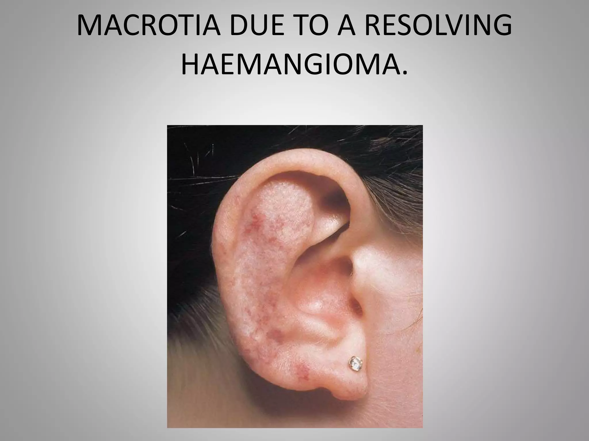 CONGENITAL MALFORATION OF EAR AND ITS MANAGEMENT | PPTX