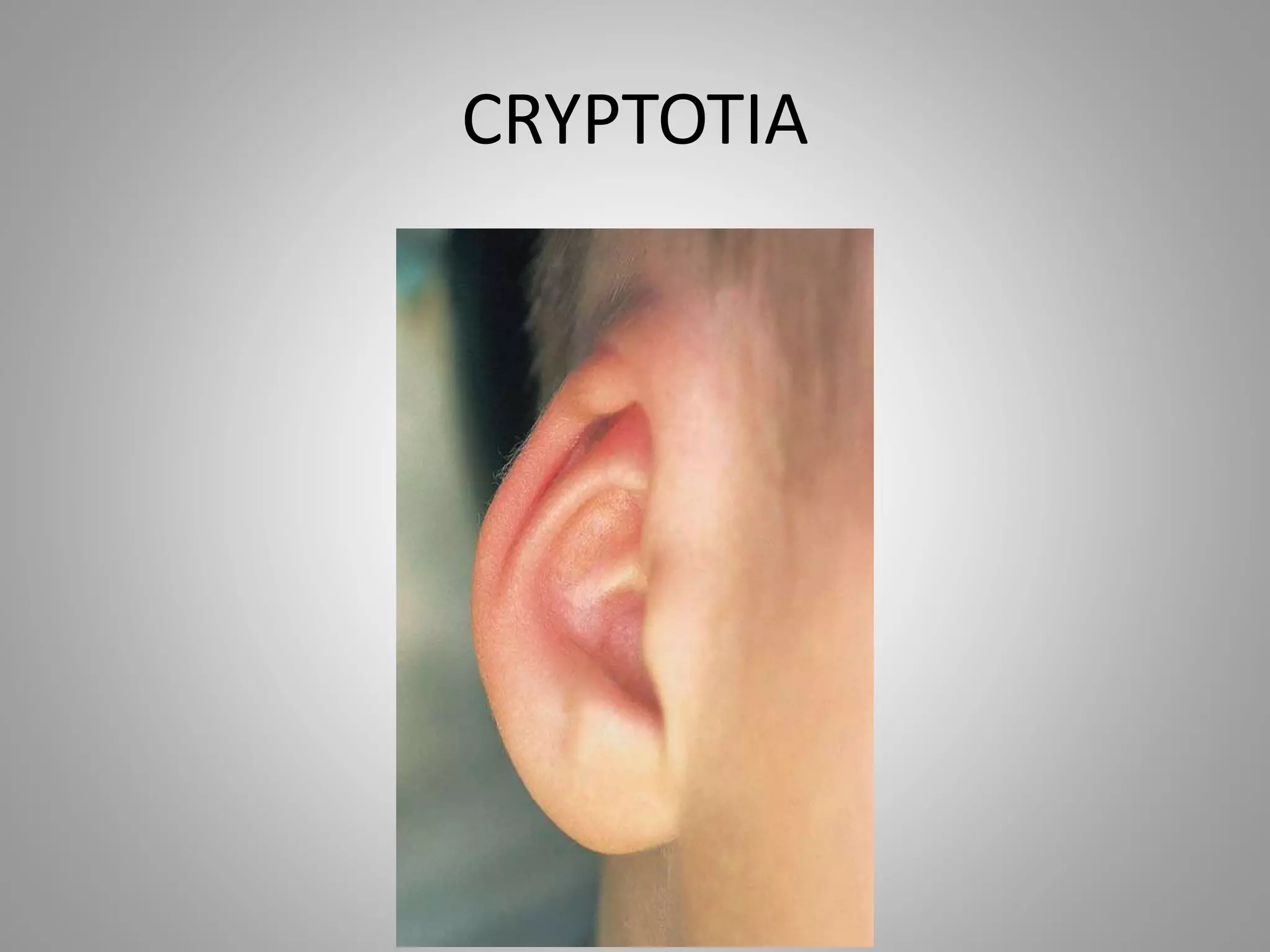 CONGENITAL MALFORATION OF EAR AND ITS MANAGEMENT | PPTX