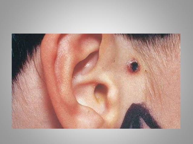 CONGENITAL MALFORATION OF EAR AND ITS MANAGEMENT | PPTX | Ear, Nose and ...