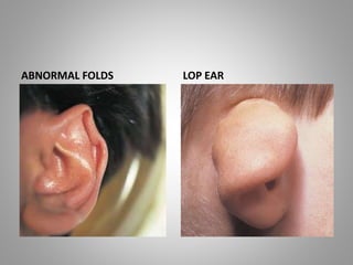 CONGENITAL MALFORATION OF EAR AND ITS MANAGEMENT | PPTX