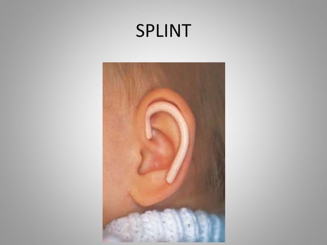 CONGENITAL MALFORATION OF EAR AND ITS MANAGEMENT | PPTX | Ear, Nose and ...