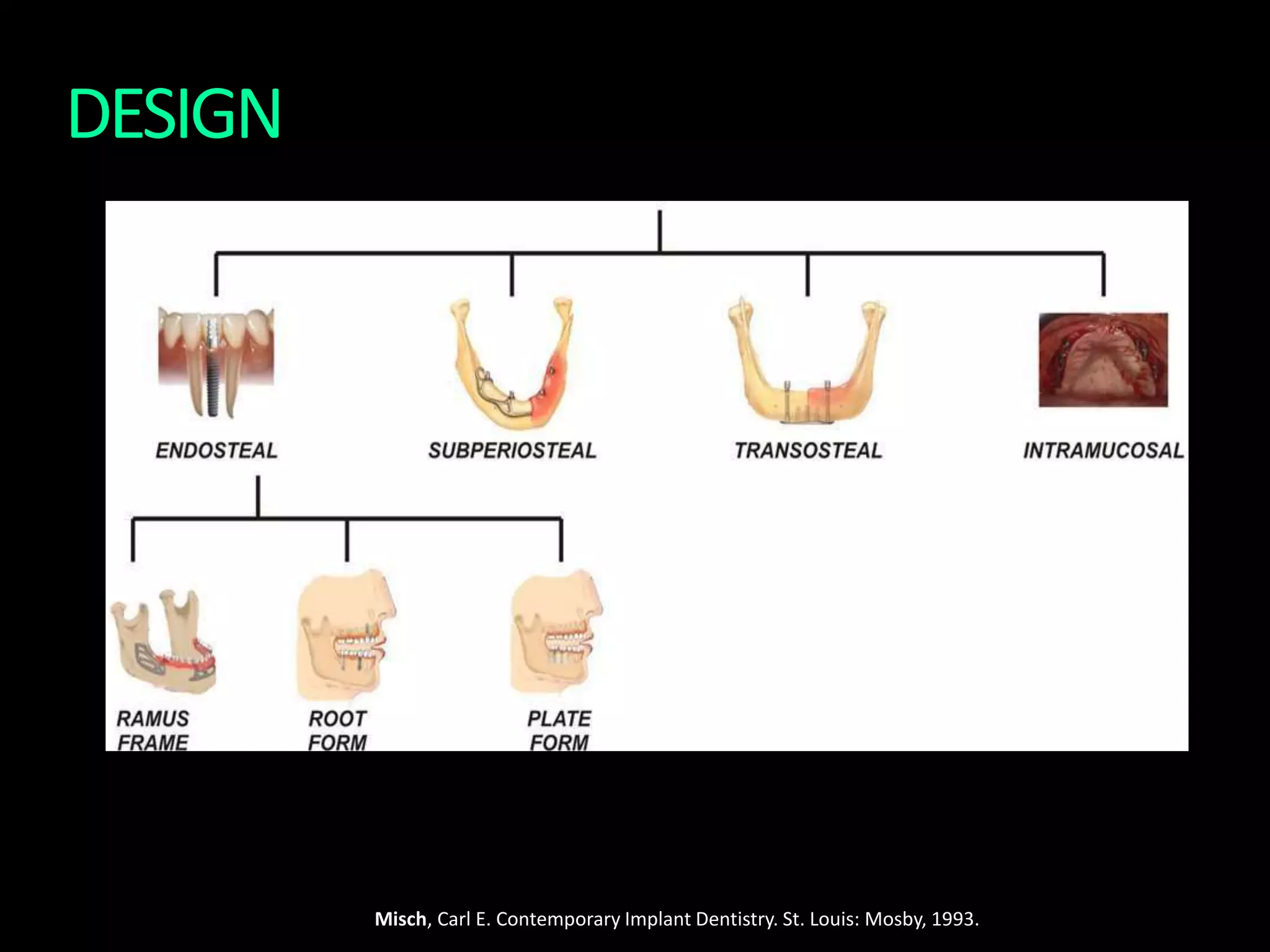 Implant design | PPTX