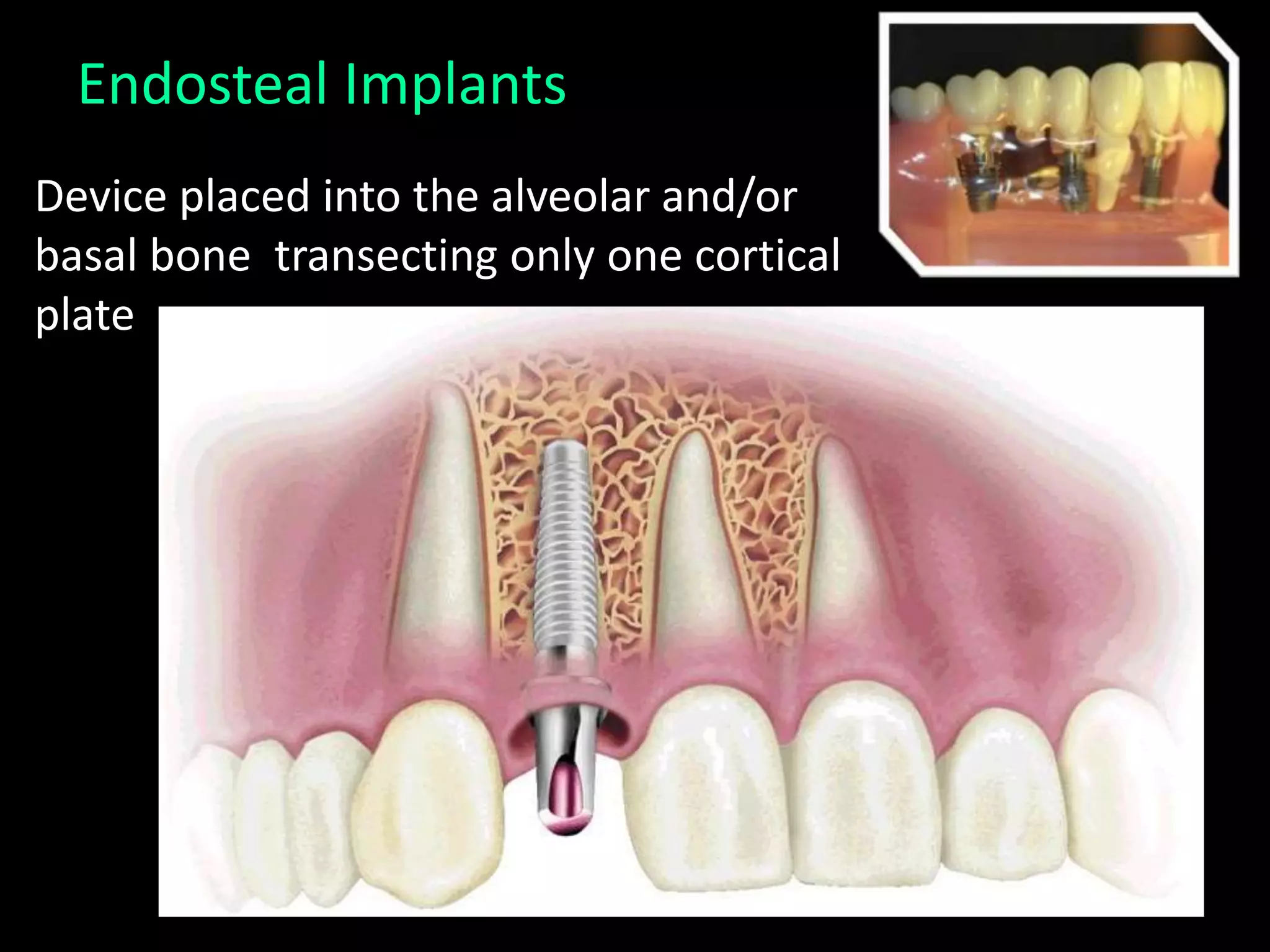 Implant design | PPTX