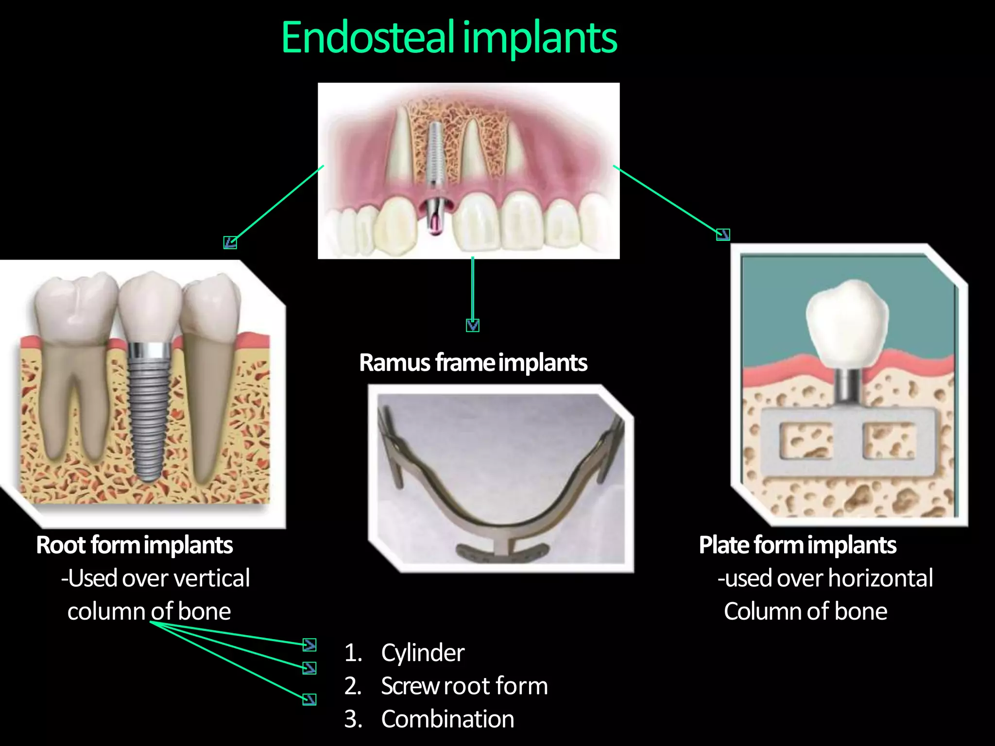Implant design | PPTX