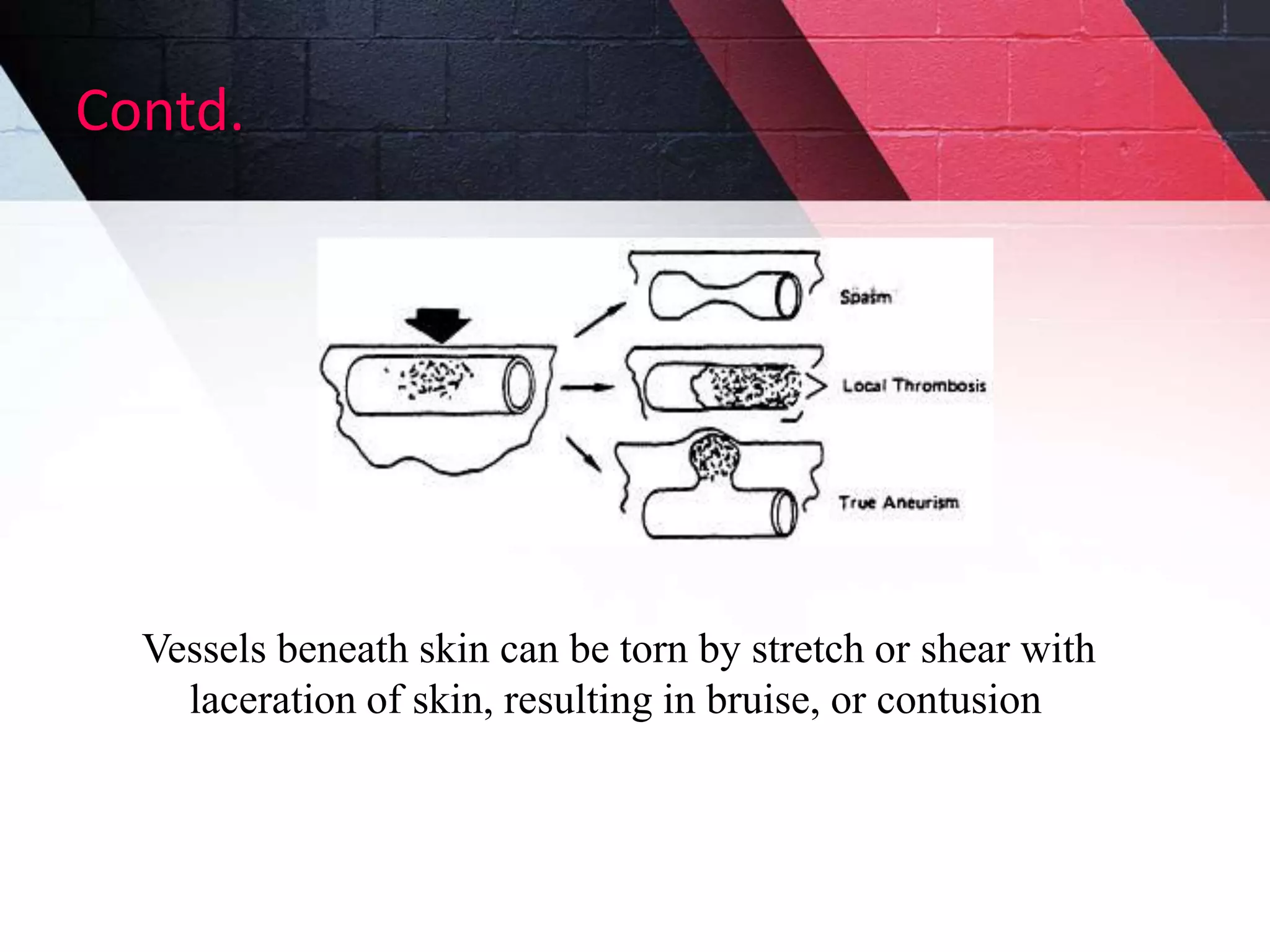 Biomechanics of Injury | PPTX