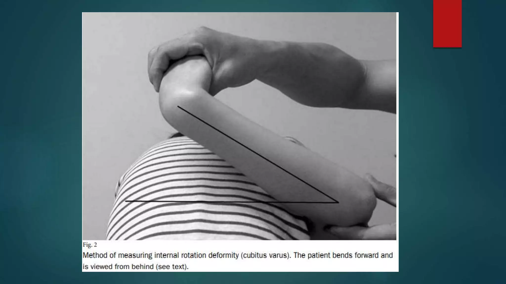 Deformities around elbow and management | PPTX