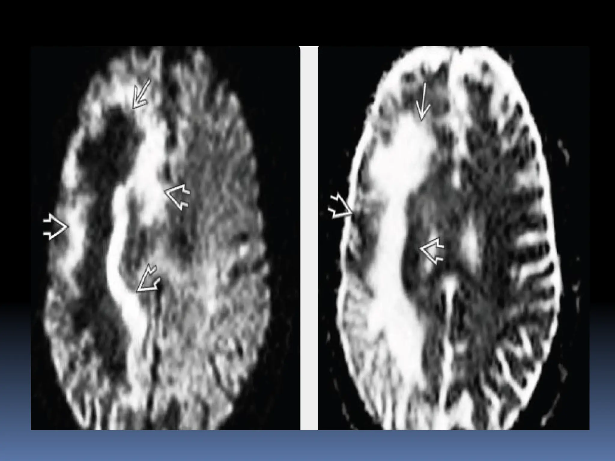 NEUROIMAGING IN HIV AND NEUROINFECTIONS.pptx