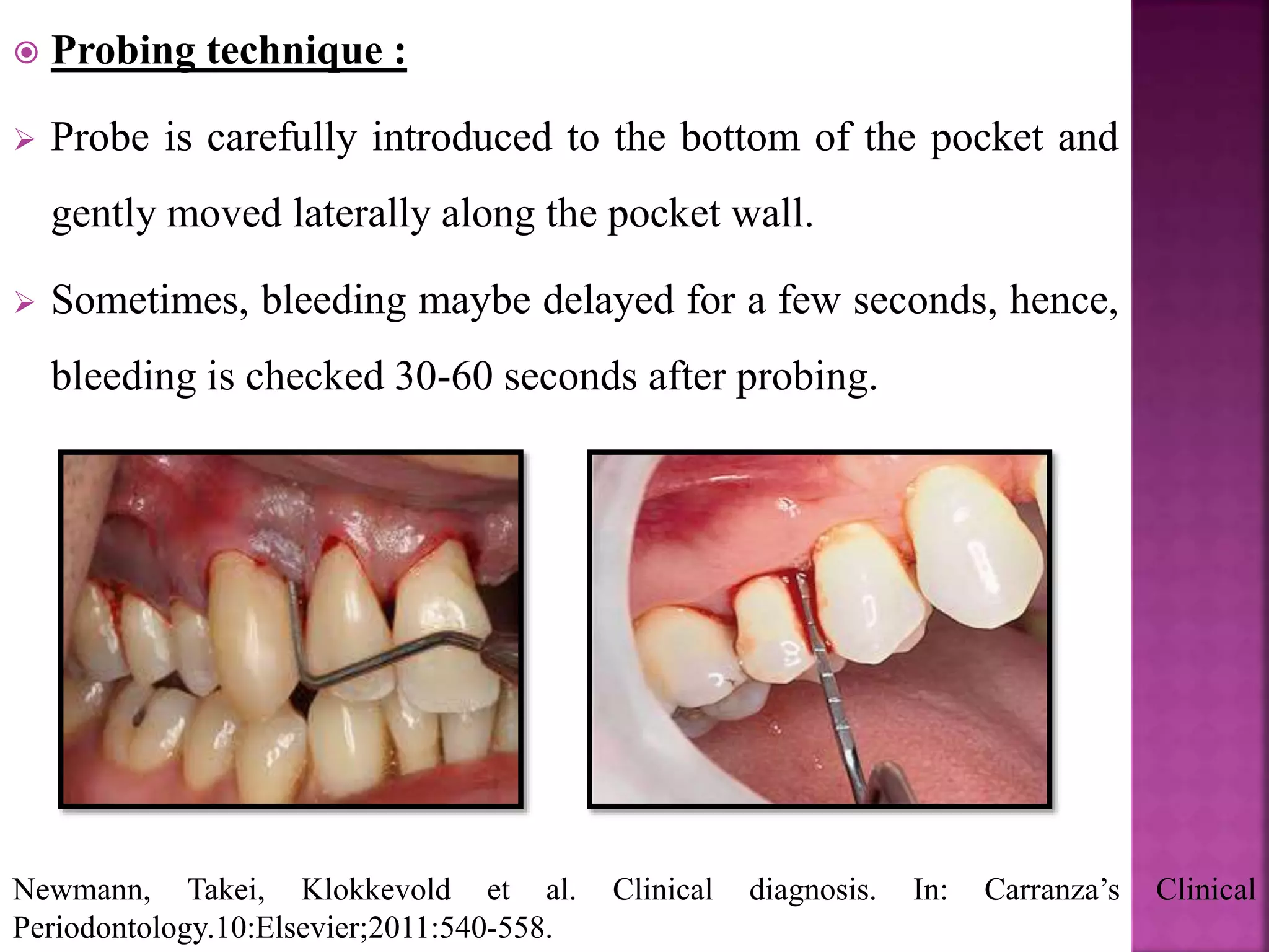 bleeding on probing | PPTX