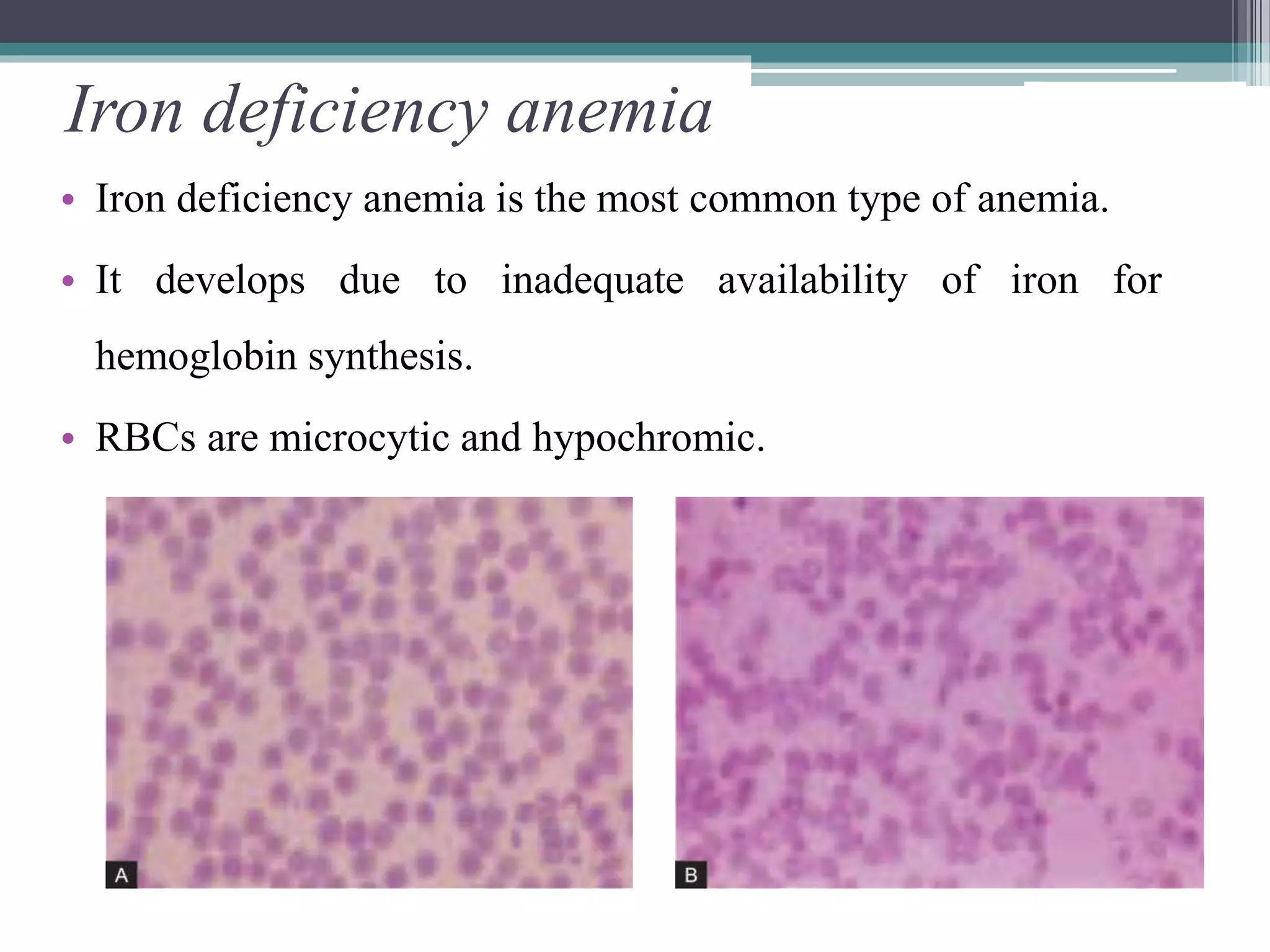anemia- oral health | PPTX