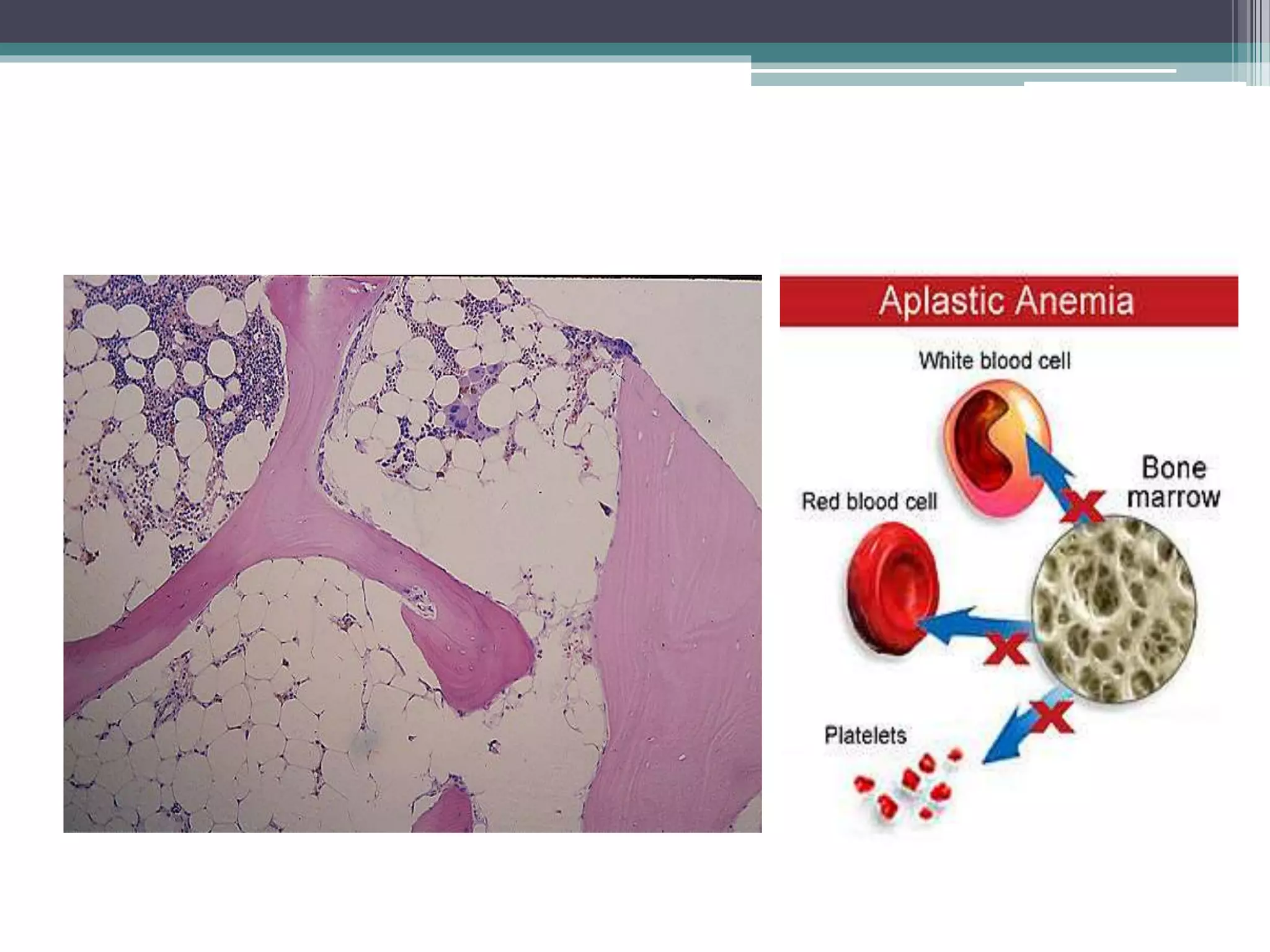 anemia- oral health | PPTX