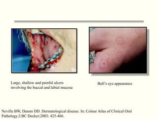 desquamative lesions of gingiva | PPTX
