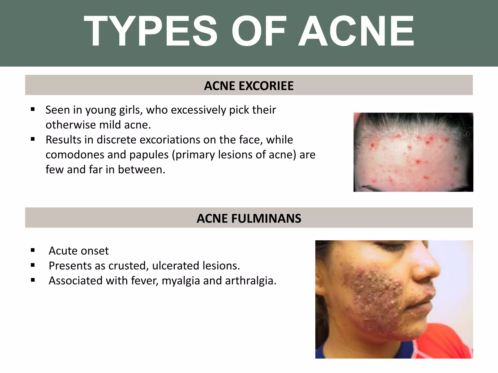 Acne Vulgaris | PPTX