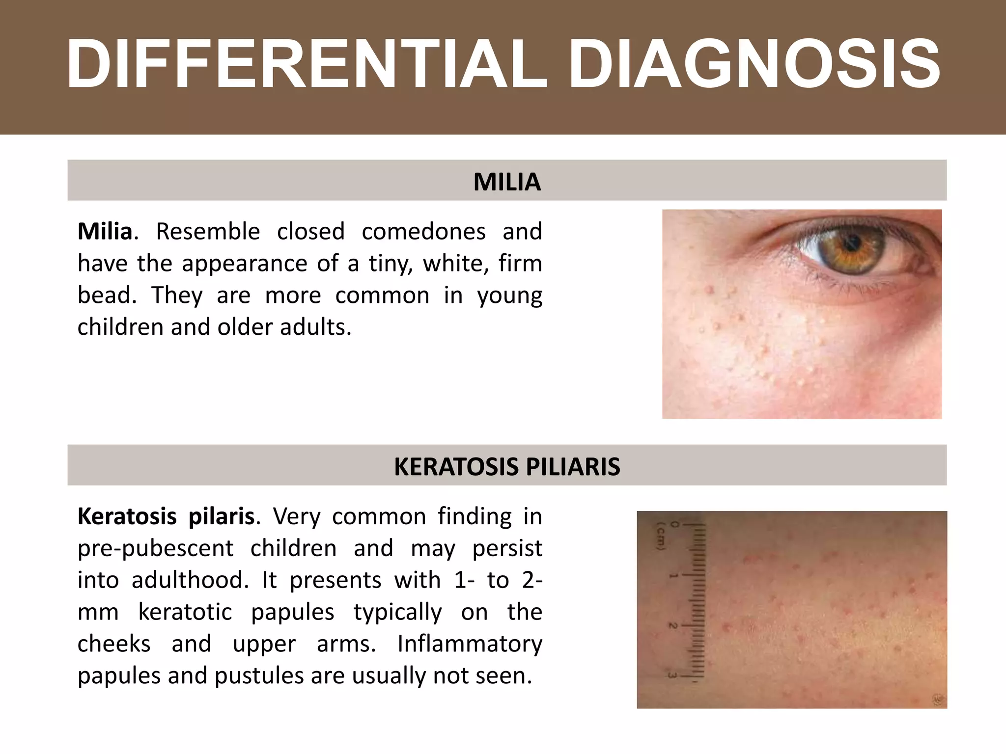 Acne Vulgaris | PPTX