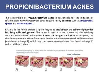 Acne Vulgaris | PPTX