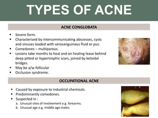 Acne Vulgaris | PPTX