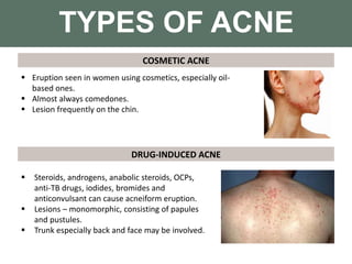 Acne Vulgaris | PPTX