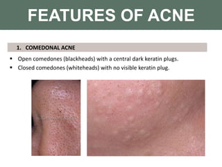 Acne Vulgaris | PPTX
