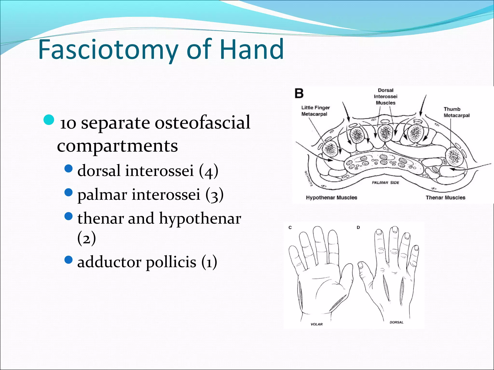 compartment syndrome | PPT